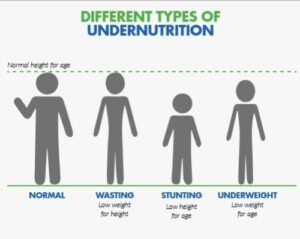 Nutritional and Digestive Disorders - PEM - W3schools